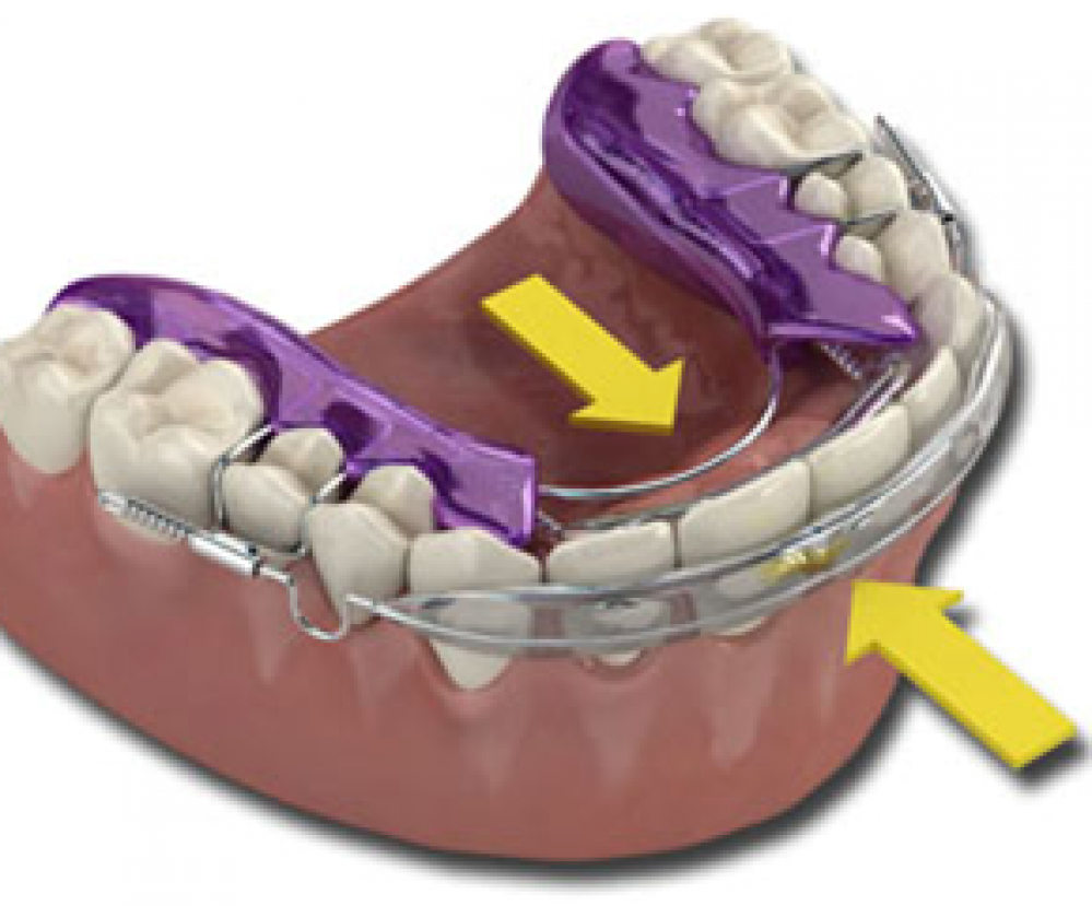Inman Aligner | Buttercross Dental Practice
