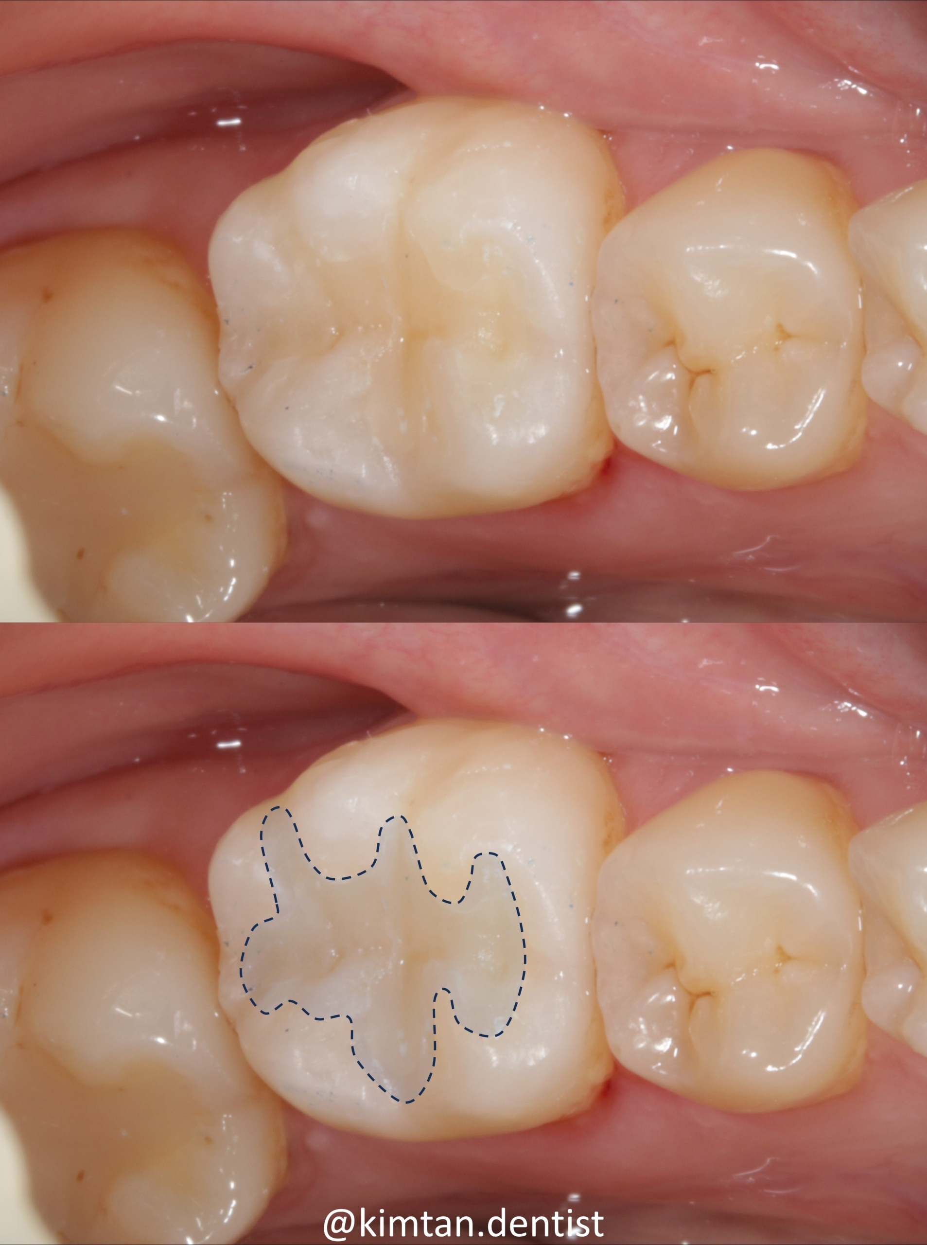 Composite Filling - Buttercross Dental Practice | Dental Surgery Witney